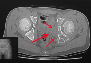 Ewing's sarcoma - Oncosurgery
