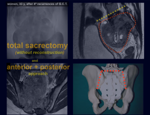 Total sacrectomy technique using Gigli saws Part I - Oncosurgery