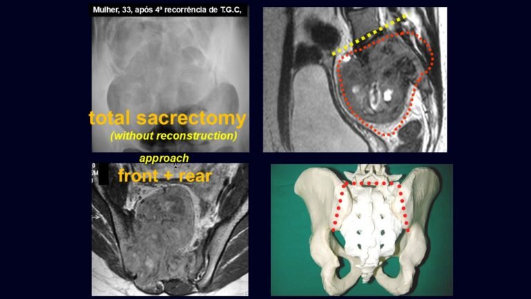 Total sacrectomy without reconstruction - Part I - Oncosurgery