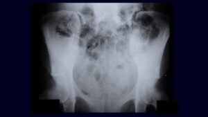 Total sacrectomy without reconstruction - Part I - Oncosurgery