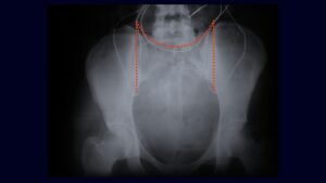 Total sacrectomy without reconstruction - Part I - Oncosurgery