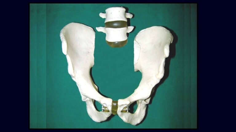 Total sacrectomy without reconstruction - Part I - Oncosurgery