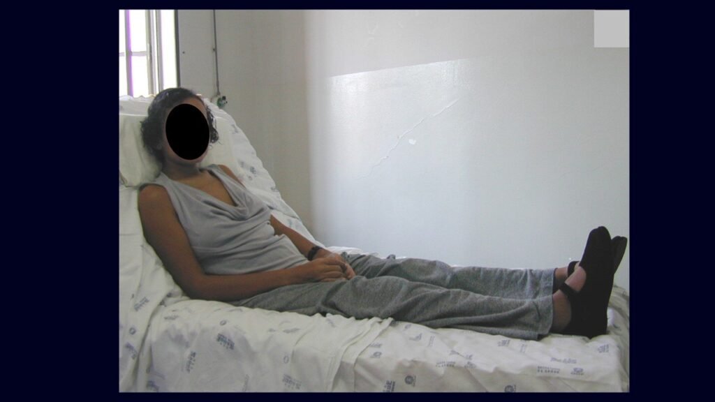 Total sacrectomy without reconstruction - Part I - Oncosurgery