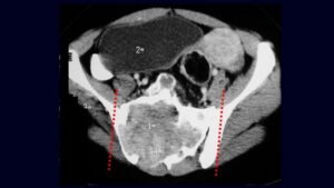 Total sacrectomy without reconstruction - Part I - Oncosurgery