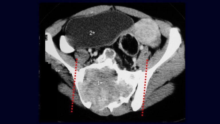 Total sacrectomy without reconstruction - Part I - Oncosurgery