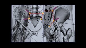 Total sacrectomy without reconstruction - Part I - Oncosurgery